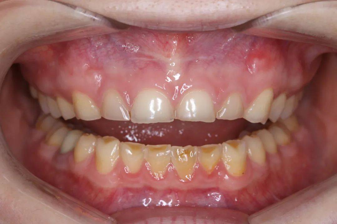 Prevention and Restoration of Tooth Wear: The Secret to Extending Tooth ...